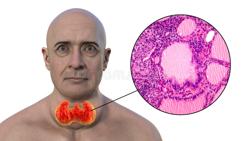 A Man with Enlarged Thyroid Gland, 3D Illustration, and Micrograph ...