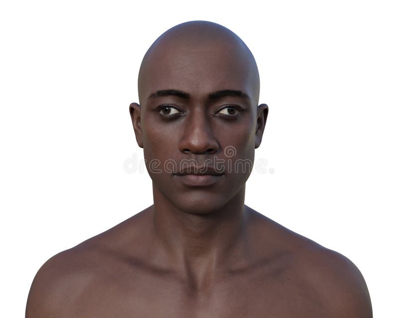 A Man with Exotropia, 3D Illustration Stock Illustration - Illustration ...