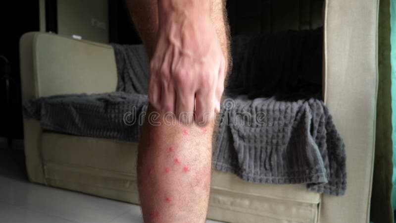Man Experiencing Skin Irritation with Visible Stock Video - Video of ...