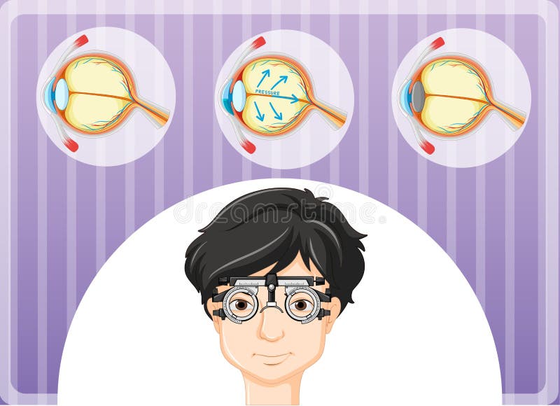 Man with Eyeglasses and Eyes Problem Stock Vector - Illustration of ...