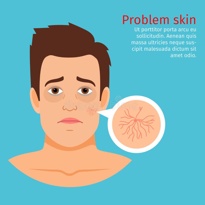 Man Face Skin Problem Buried Capillaries Stock Vector - Illustration of ...
