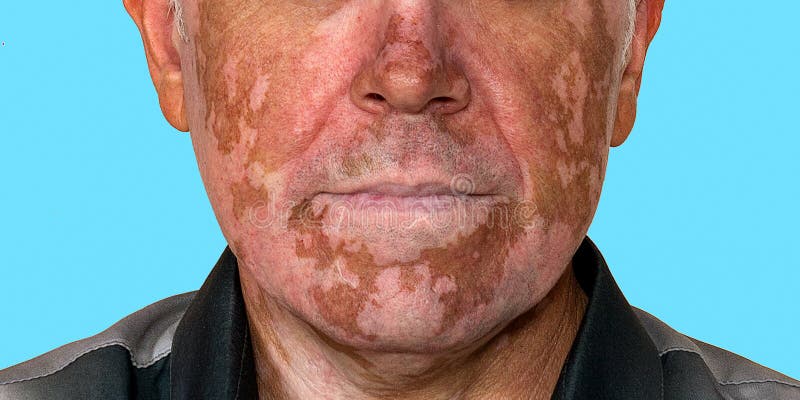 Vitiligo stock photo. Image of senior, nonsegmental, pigmentation ...