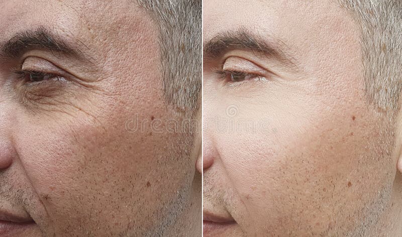 Male Face Wrinkles before and after Treatment Stock Photo - Image of ...