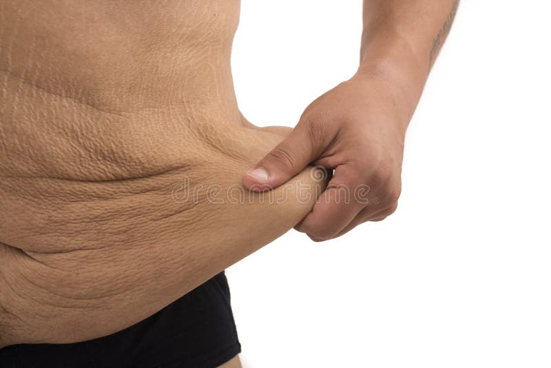 Stretch Marks Men Groin