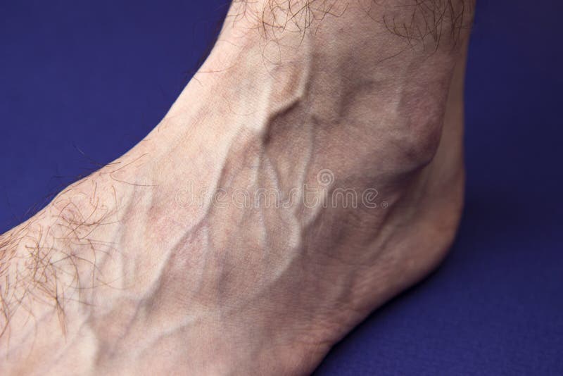 A Man Foot with a Mesh of Dilated Varicose Veins Stands on a Blue ...