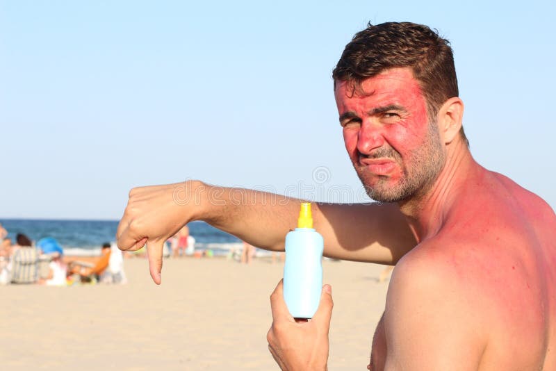 Sunburned Stock Images - Download 1,537 Royalty Free Photos