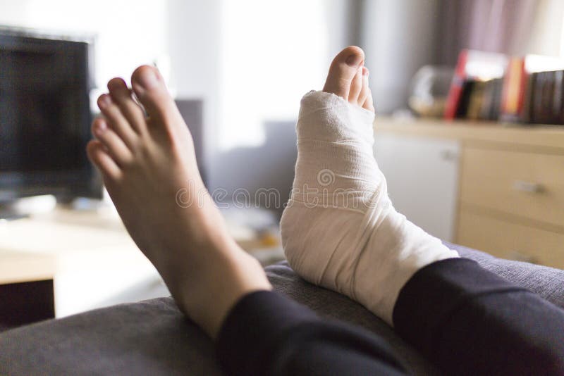 Grounded at Home with a Leg in a Cast Stock Photo - Image of bandage ...