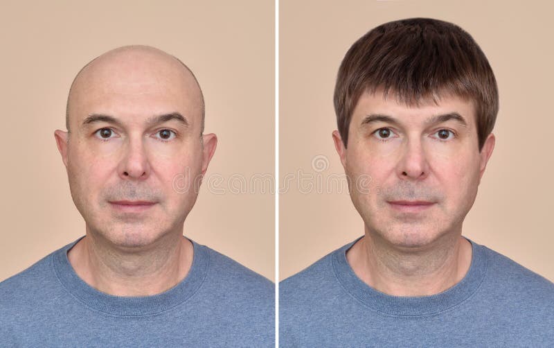 Man with and without hair stock photo. Image of health - 125715460