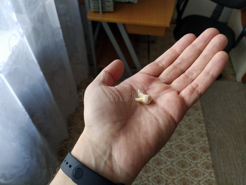 Man Hand Holds an Extracted Tooth Stock Photo - Image of extracted ...