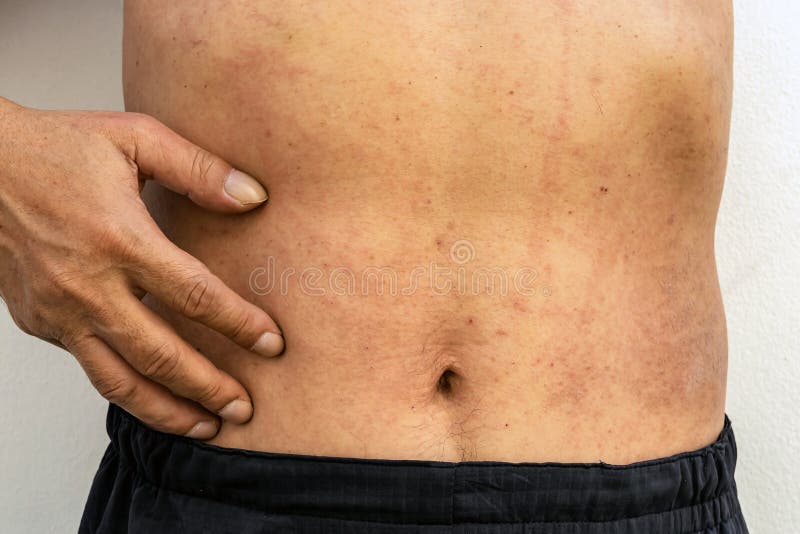 Man Hand Scratching An Itch On Red Mark Sensitive Skin Male Torso With