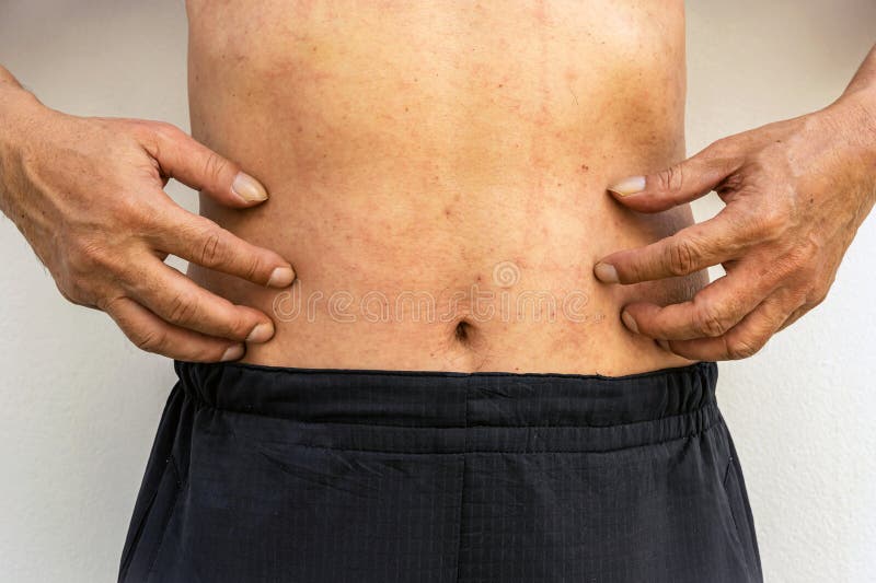 Itchy Body Rash Caused By Allergies On Middle Part Of Man Body Male Torso With Red Allergic