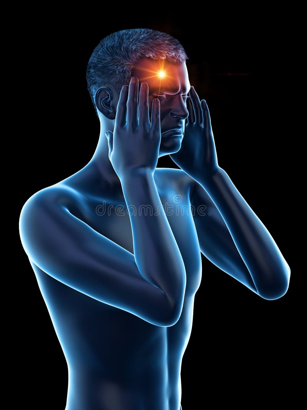 Cluster Headache Stock Illustrations – 462 Cluster Headache Stock ...