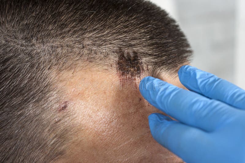 Man with a Head Wound at the Doctor`s Appointment Stock Photo - Image ...
