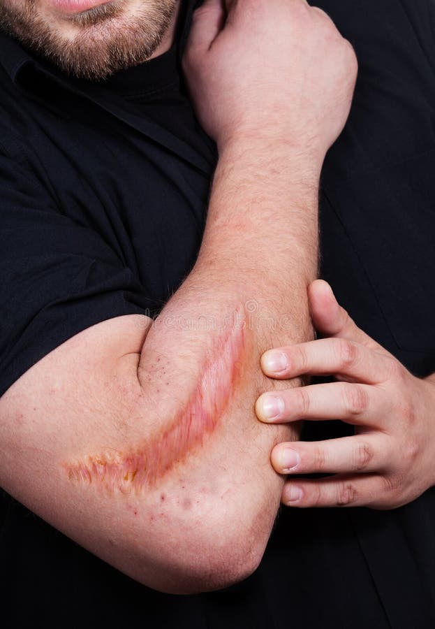 Man with Heavy Scar on His Arm Stock Image - Image of burn, accident ...