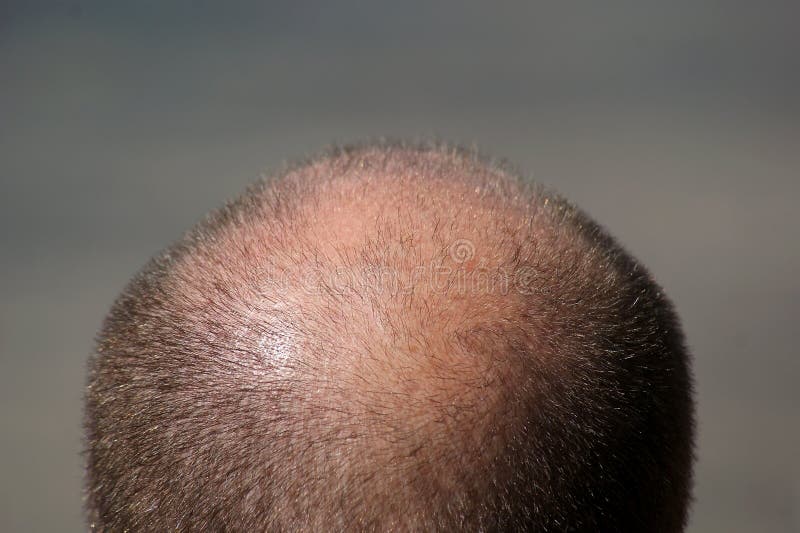 Man Hoofd van Balding stock afbeelding. Image of gezondheid - 18551517