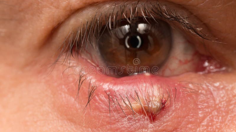 Man with Stye on Eye stock image. Image of human, care - 213568337