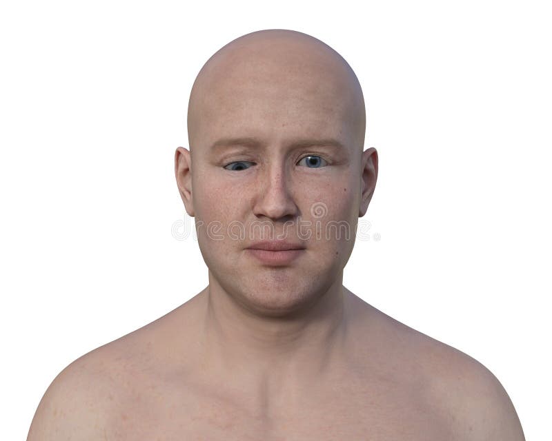 A Man with Hypotropia, 3D Illustration Stock Illustration ...