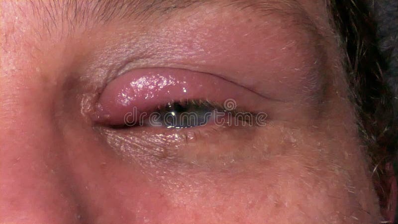 Man with infected eye stock video. Video of caucasian - 65767637