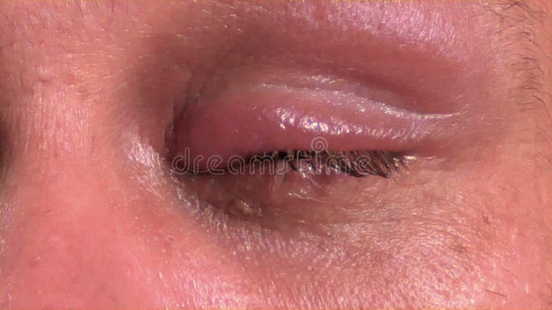 Man with infected eye stock video. Video of macro, festering - 65771635
