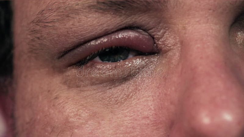 Man with infected eye stock video. Video of drops, medical - 65769101