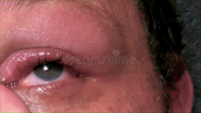 Man with infected eye stock footage. Video of inflammation - 65770482