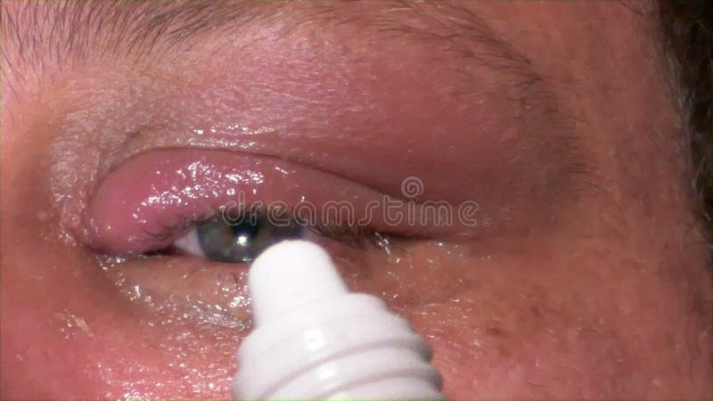 Man with Infected Eye Putting in Eye Drops Stock Footage - Video of ...