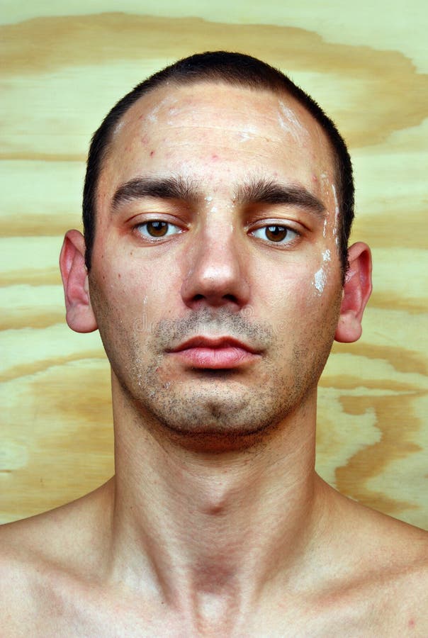 Man with Infected Skin on the Face Stock Image - Image of allergic ...