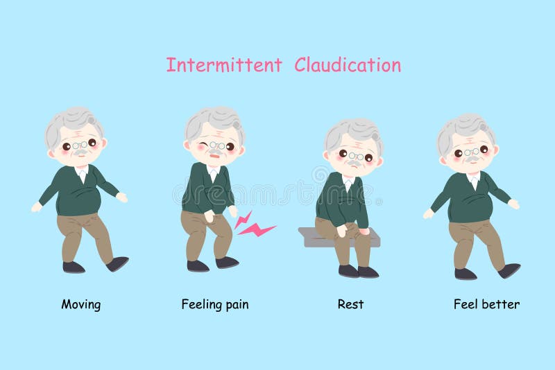 Man with Intermittent Claudication Stock Illustration - Illustration of ...