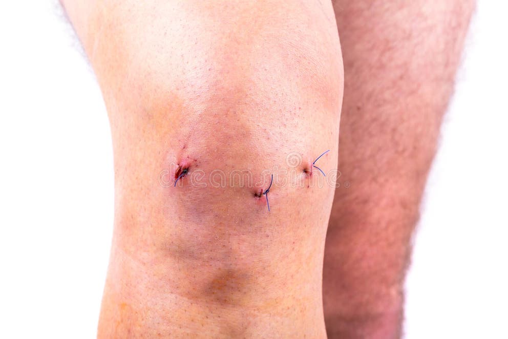 Man Knee after Arthroscopic Surgery Stock Image - Image of muscle ...