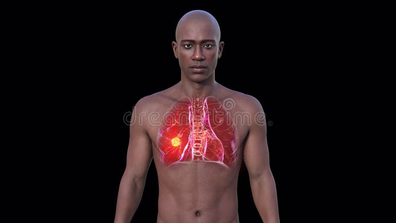 Lung cancer, 3D animation stock footage. Video of abnormalities - 354786954
