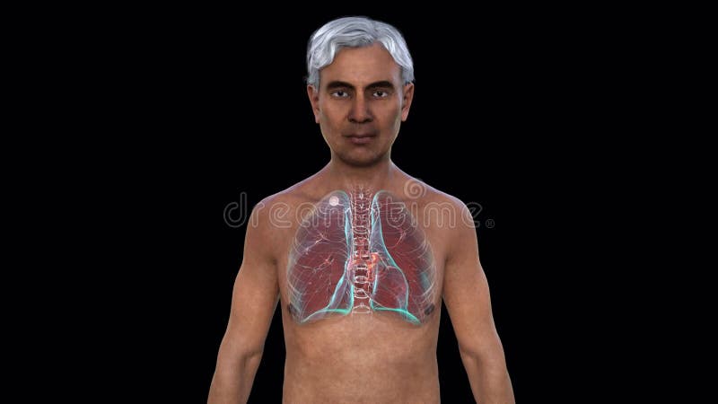 Man with Tuberculosis, 3D Animation Stock Video - Video of pulmonology ...