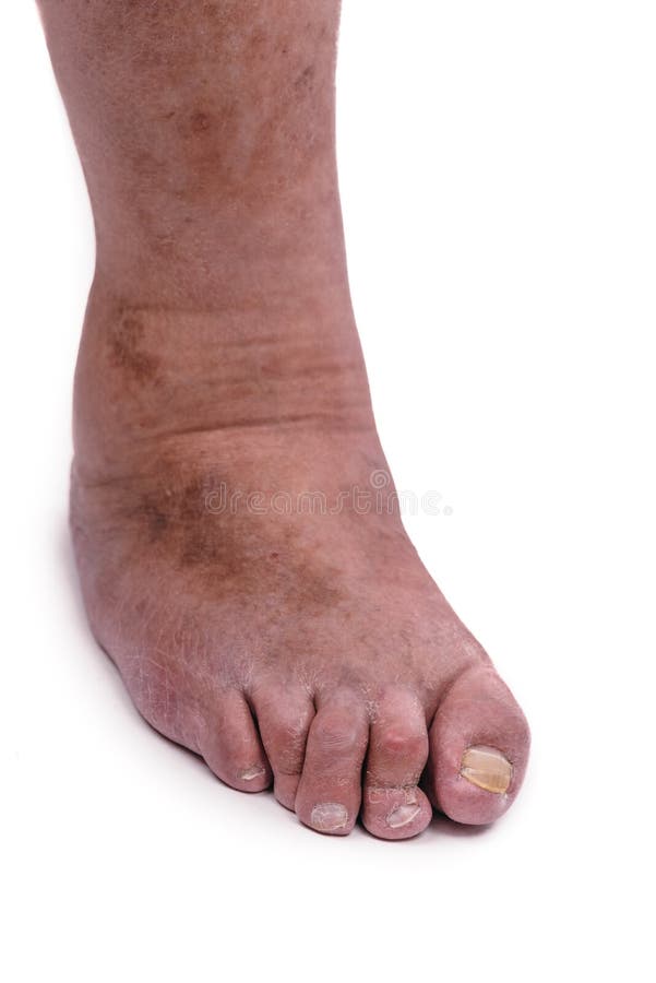 Man Med En Diagnos Av Polyarthritis Arkivfoto - Bild av gammalt, gikt ...