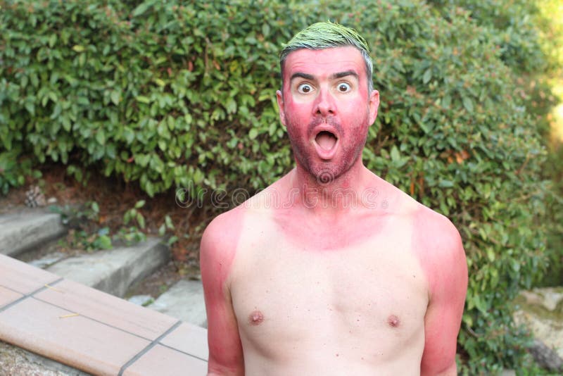 Man with Pale Complexion Getting Sunburnt Stock Image - Image of meme ...
