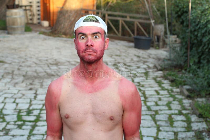 Man with Pale Complexion Getting Sunburnt Stock Image - Image of meme ...