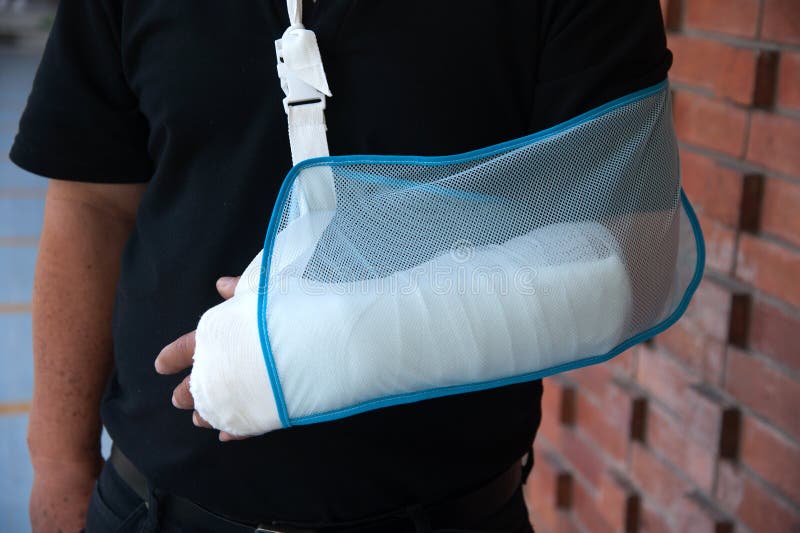 Man with a Plaster because Broken Arm. Stock Photo - Image of hurt ...