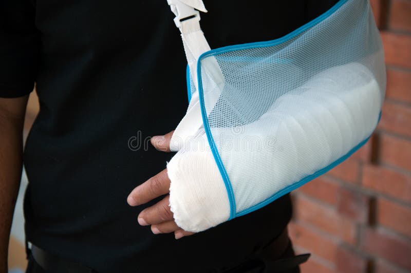 Man with a Plaster because Broken Arm. Stock Photo - Image of hand ...