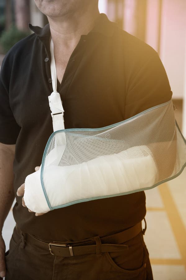 164 Broken Left Arm Stock Photos - Free & Royalty-Free Stock Photos ...