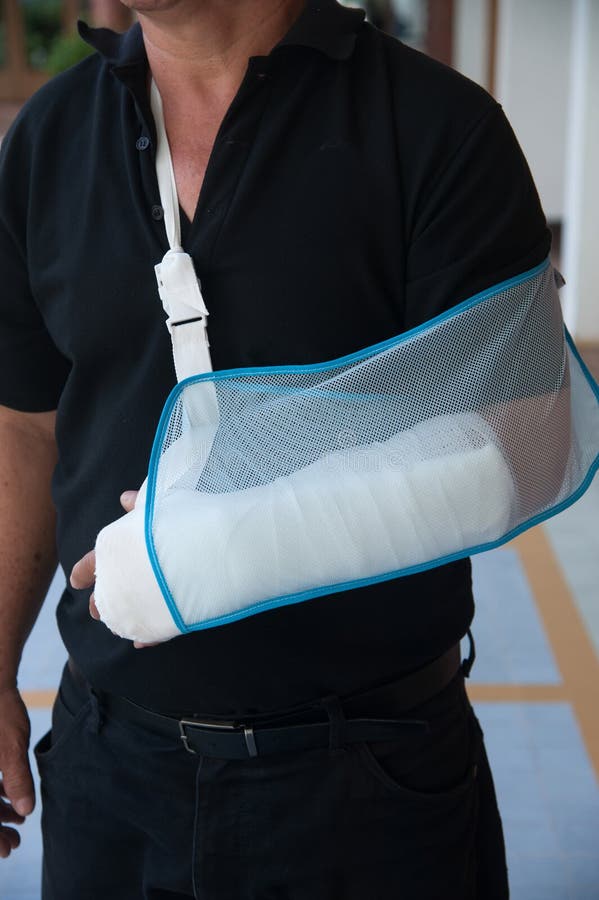 Man with a Plaster because Broken Arm. Stock Photo - Image of physical ...