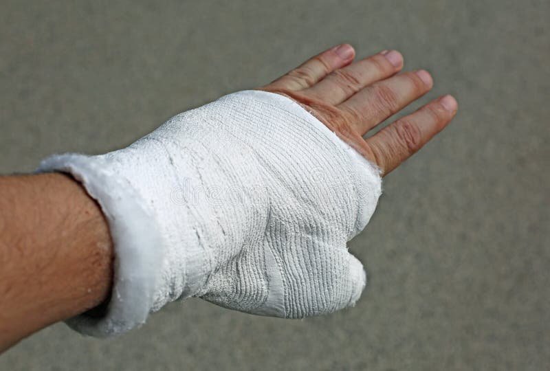 Hand Plastered after a Fracture Due To an Accident Stock Image - Image ...