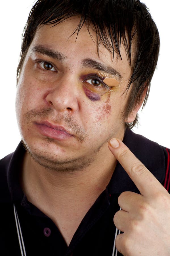 Man Pointing at His Black Eye Stock Image - Image of point, background ...