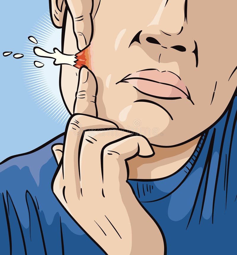 Boy Popping Zit stock vector. Illustration of puss, disgusting - 24681170