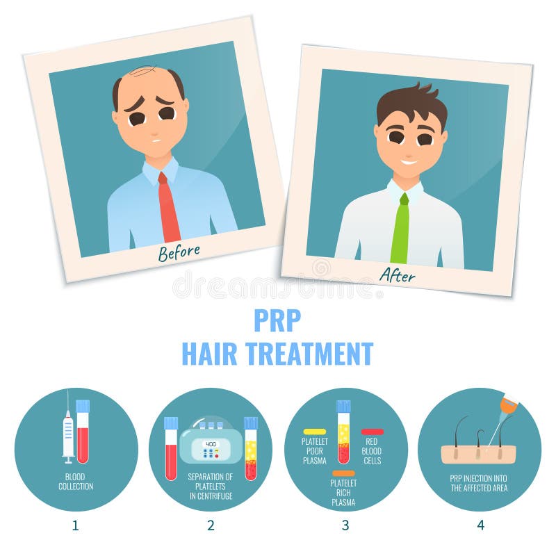 Prp Method Stock Illustrations – 150 Prp Method Stock Illustrations ...