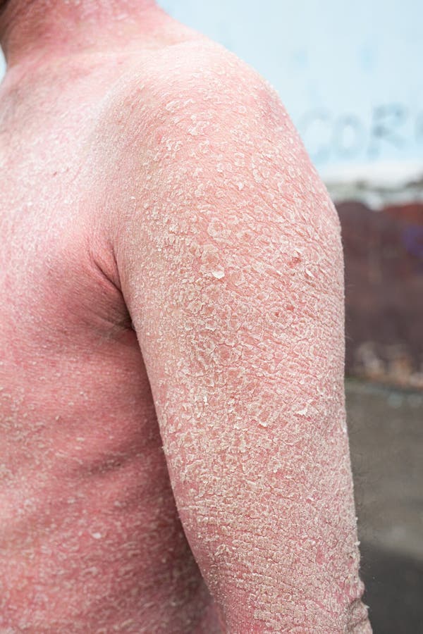 A Man with Psoriasis on His Back and Neck. Scratch with His Hand ...