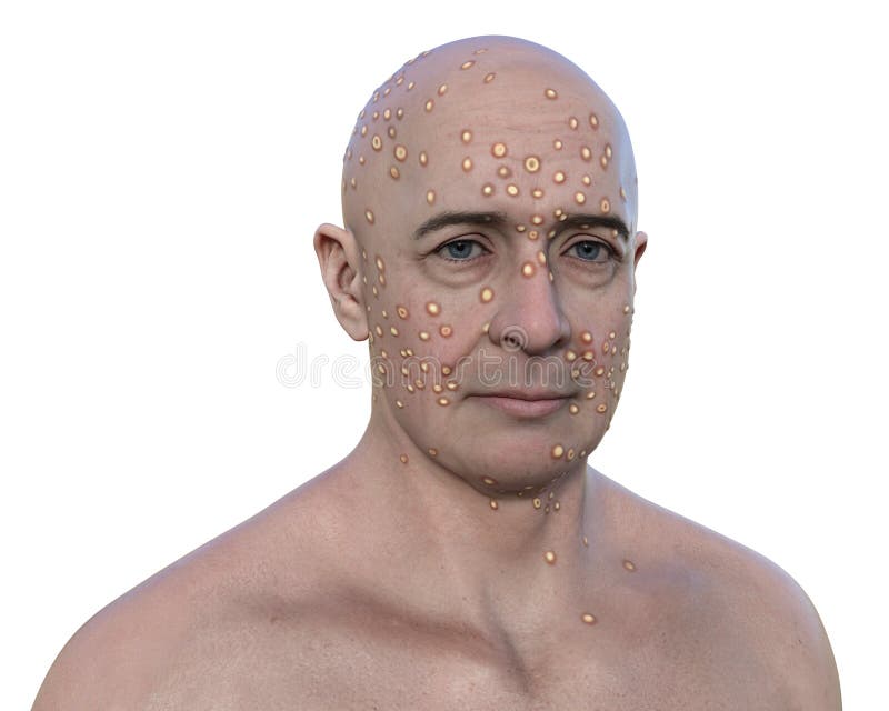 A Man with Rash from Pox Viruses, 3D Illustration Stock Illustration ...