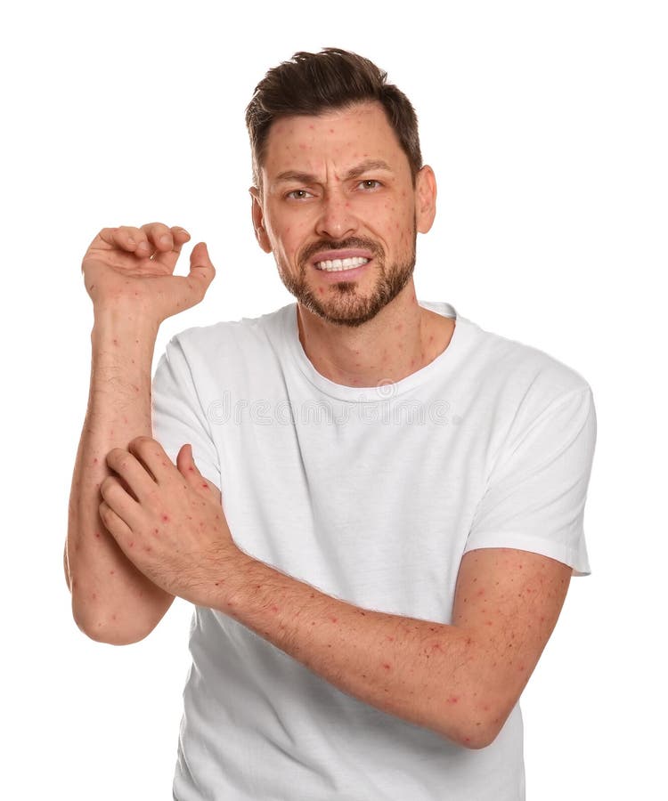 Man with Rash Suffering from Monkeypox Virus on Light Blue Background ...