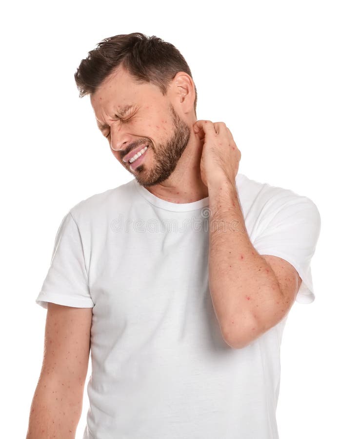 Man with Rash Suffering from Monkeypox Virus on White Background Stock ...