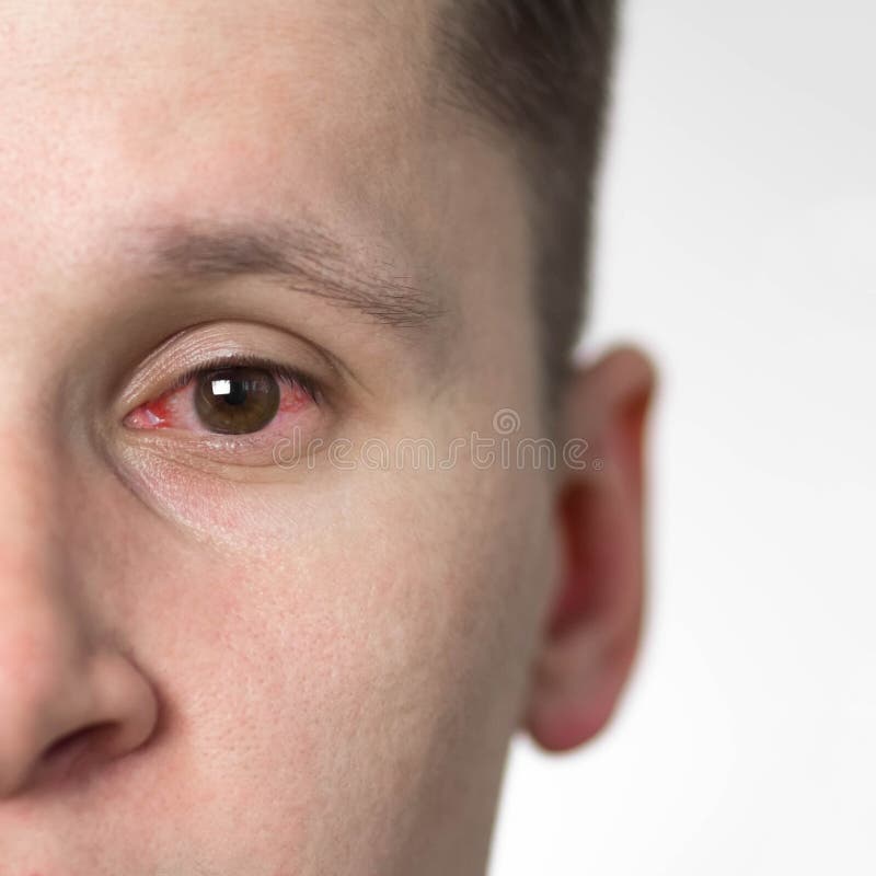 A Man with Red Eyes. Close Up Stock Image - Image of injury, fever ...