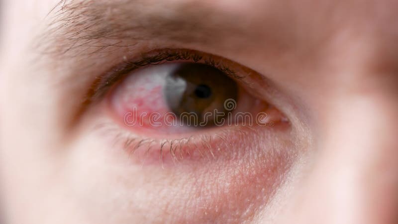 A Man with a Red, Sore Eye. an Infection during Illness Struck the Eyes ...