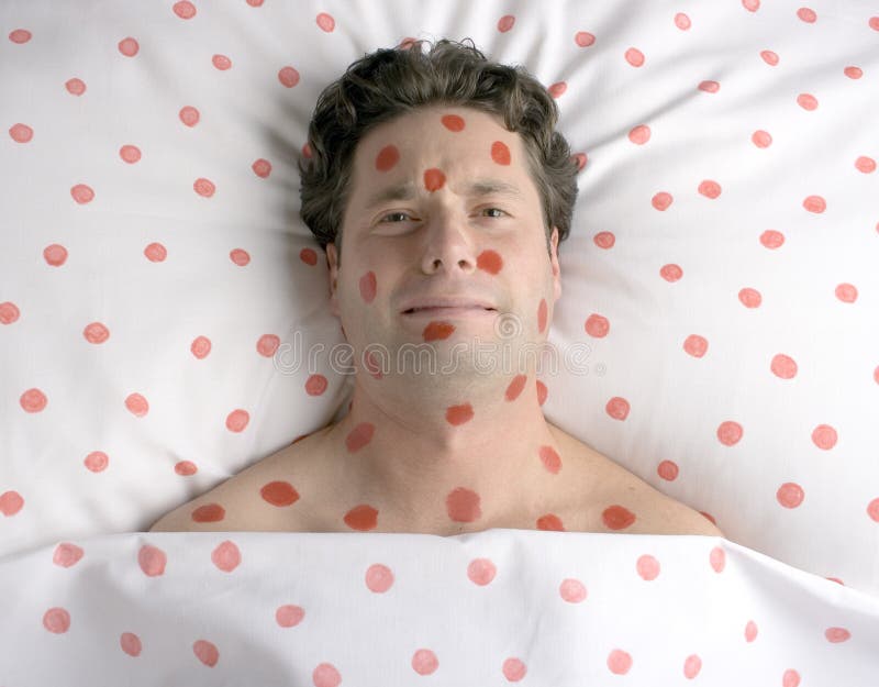 Man with Red Spots on Face and Body Stock Image - Image of sickly ...