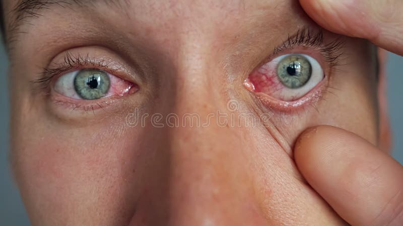 Man Rubs Red Sore Eyes with Hands Stock Image - Image of adult, pain ...